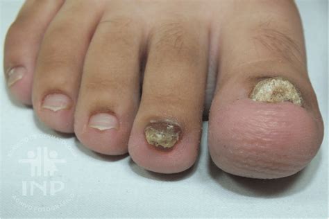 Total Dystrophic Onychomycosis