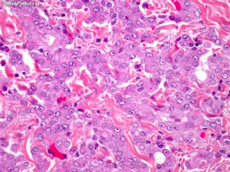 Malignant Mesothelioma Epithelioid