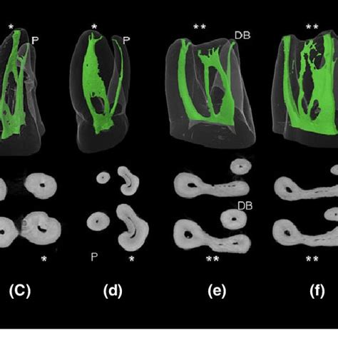 Pdf Morphological Evaluation Of Maxillary Second Molars With Fused