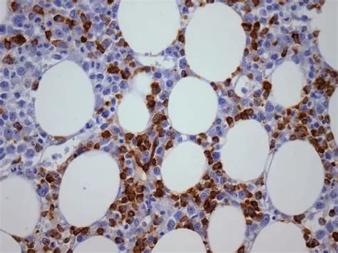 What Are Myeloid Neoplasms Pathosomes