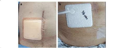 A Simple Dressing Application Used In The Control Group B PICO Download Scientific Diagram