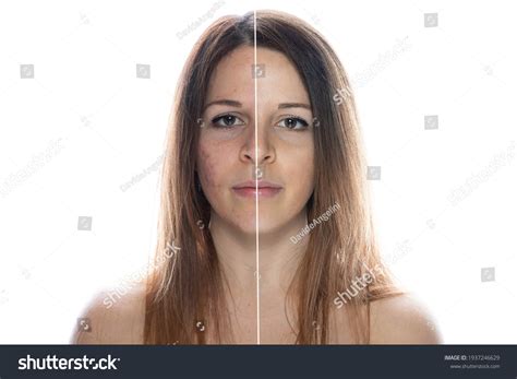 Cream Before After Images Stock Photos Vectors Shutterstock