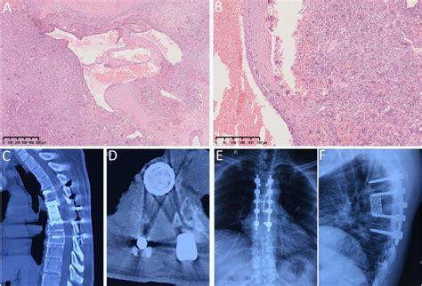 Postoperative Histopathological Investigation And Radiological