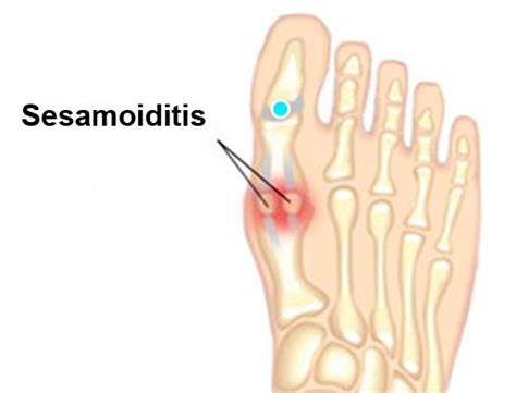 My Micro Injuries Sesamoiditis To Bursitis Runner Diaries