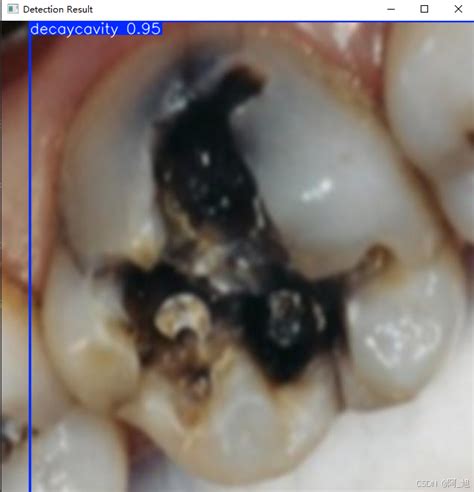 基于深度学习的蛀牙智能检测与语音提示系统【python源码pyqt5界面数据集训练代码】 Csdn博客
