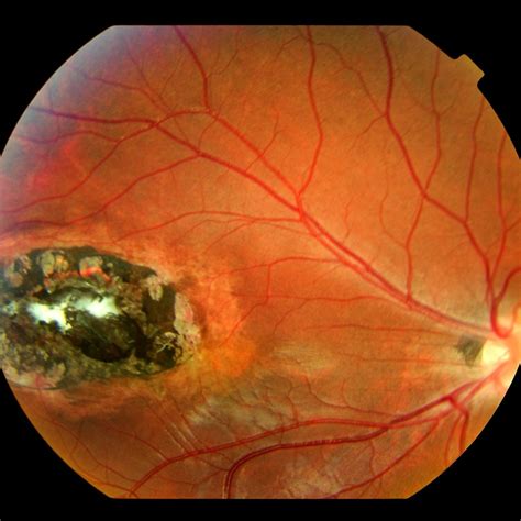 Toxoplasmosis Ocular Dr Reichmann