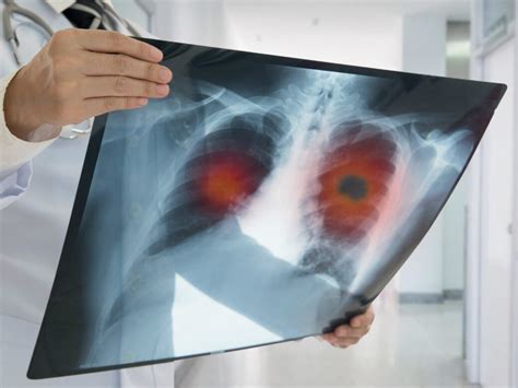 AI Algorithm May Enhance Lung Cancer Detection Study Finds