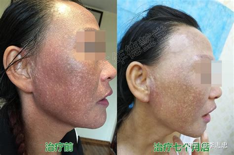 德懿堂治疗瑞尔氏黑变病临床效果好 知乎