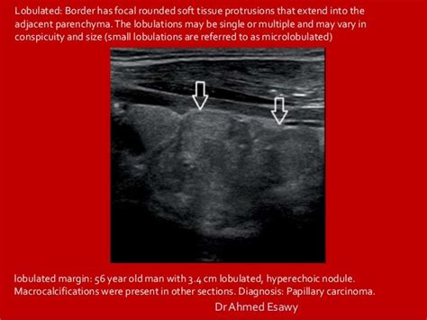 Tirads Thyroid Nodule Imaging Reporting And Data System Dr Ahmed E