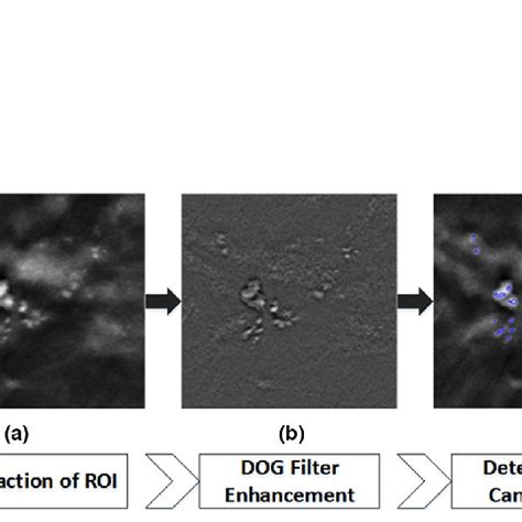 Microcalcification Cluster Segmentation Process Demonstration On A