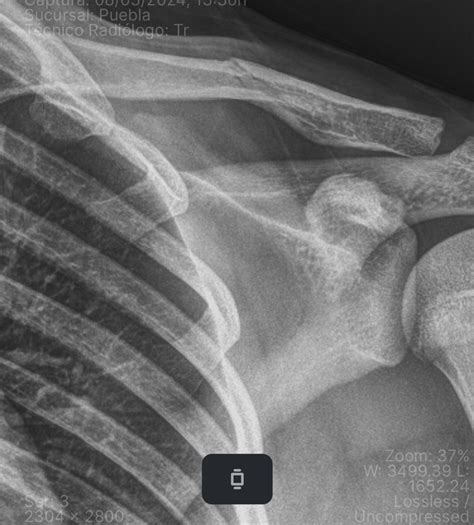 Broken Clavicle Fit R Mensfashion
