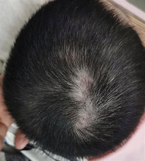 Asymptomatic Hair Loss In A Patient With Systemic Lupus Erythematosus