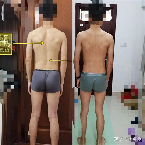 久坐腿麻不一定是腰突！ 知乎