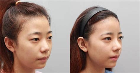 做自体肋软骨隆鼻效果怎么样？ 知乎
