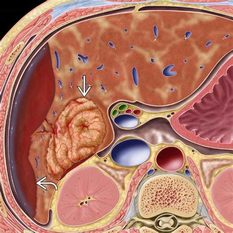Hepatic Adenoma Clinical Gate