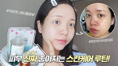 뒤집어지는 민감피부🚨피부 진짜 좋아지는 여드름 스킨케어 루틴 2탄 공개 Ft모닝 And 나이트 모두 가능ㅣhasomy 하소미