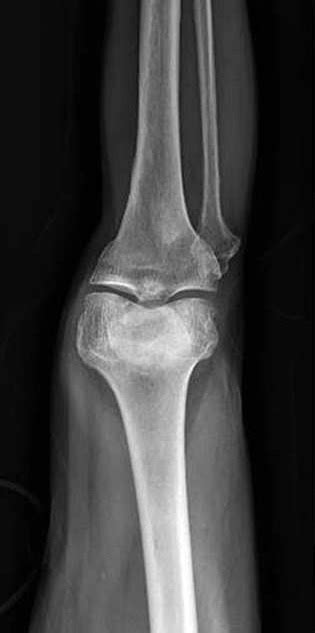 Radiographs Show Kellgren Lawrence Grade 2 Osteoarthritis Of The Left Knee Download