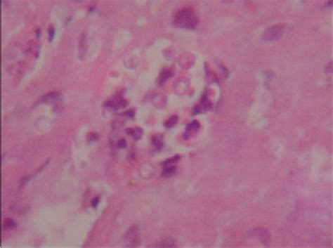 Isolated Cavitary Lung Disease In A Renal Allograft Recipient A Rare Manifestation Of
