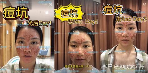 关于点阵激光治疗痘坑 10个常见问题 知乎