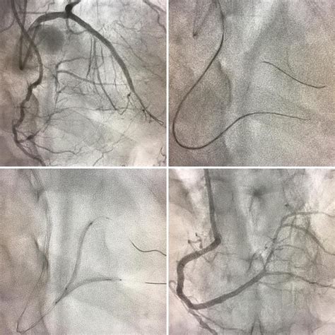 Complete Revascularization With Second Cto Pci On Rca Following Lad