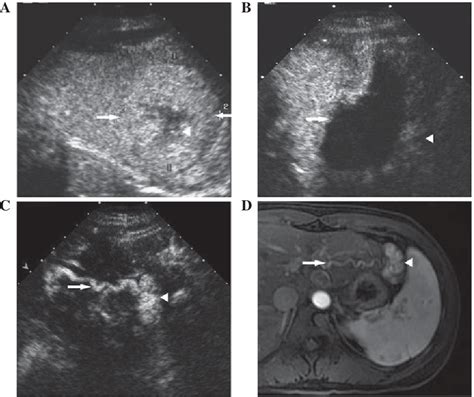 Figure 2 From Percutaneous Microwave Ablation For Benign Focal Liver Lesions Initial Clinical