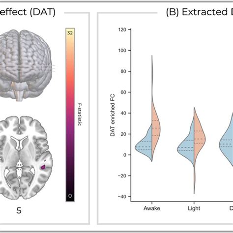 A Dat Enriched Fc Within The Right Middlesuperior Temporal Gyrus And Download Scientific