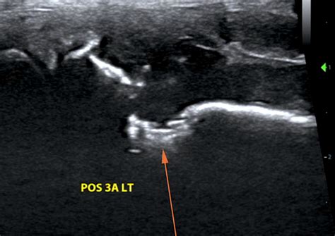 Aggressive Osteolytic Lesion In A 4 Year Old Mn Siberian Husky Our