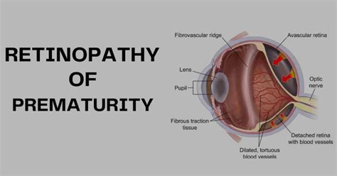 Retinopathy Of Prematurity Eyesopt