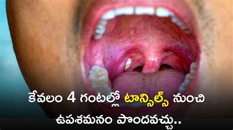 If You Drink Green Tea And Barley Water Can Reduce Tonsils In 4 Hours Cure Tonsillitis