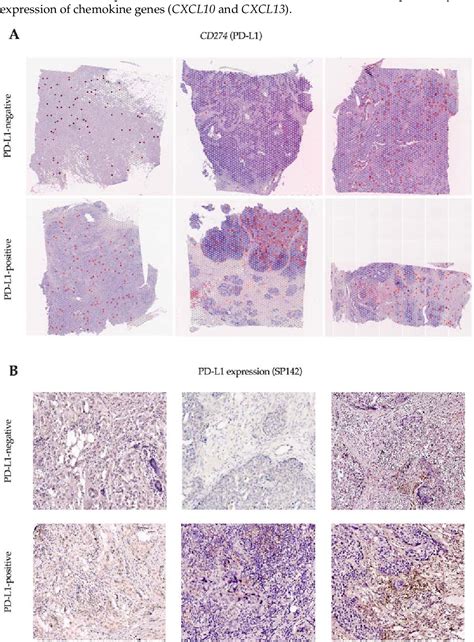 Figure 1 From Spatial Profile Of Tumor Microenvironment In Pd L1 Negative And Pd L1 Positive