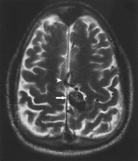 Hereditary Hemorrhagic Telangiectasia Brain