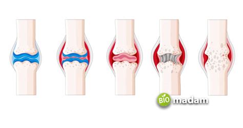 Difference Between Rheumatoid Arthritis And Osteoporosis Biomadam