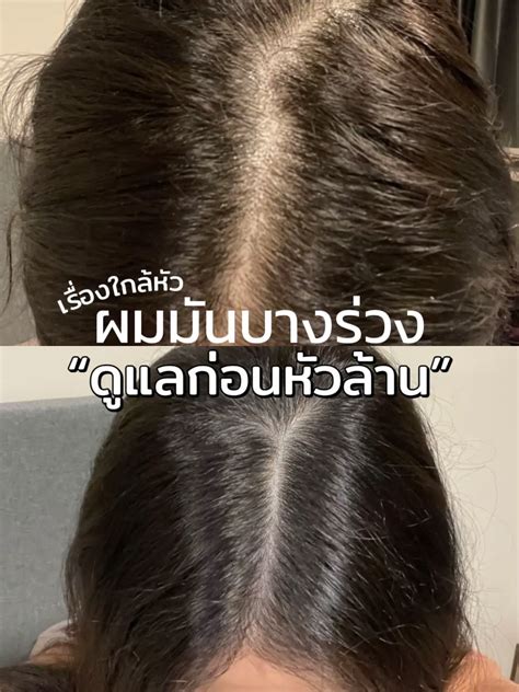วิธีแก้ผมบาง 2024 ประสบการณ์ผู้ใช้จริงบน Lemon8