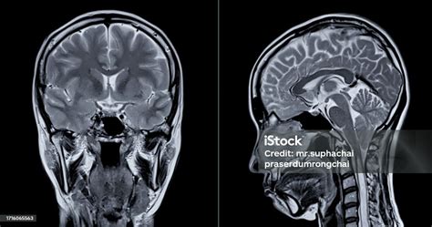 뇌의 Mri 스캔은 뇌졸중 질환 뇌종양 및 감염으로 뇌 질환을 감지합니다 Mri 스캐너에 대한 스톡 사진 및 기타 이미지