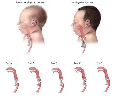 Surveillance Manual 47 Congenital Malformations Of The Digestive System