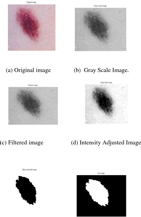 figure 2 from accurate border detection of skin lesions in skin cancer