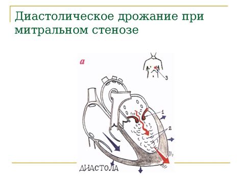 Синдромы недостаточности митрального клапана и стеноза левого