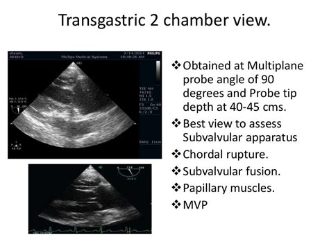 Assessment Of Mitral Valve By Tee
