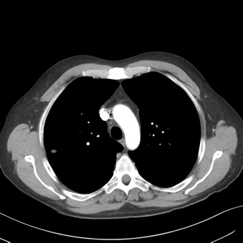 Cryptococcoma Of The Cerebellum Image