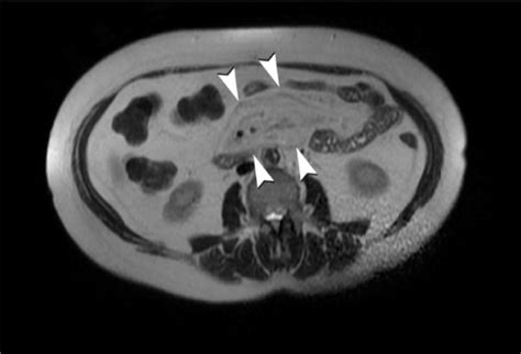 Ct And Mri Aspect Of Mesenteric Panniculitis