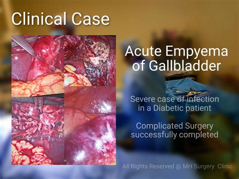Empyema Of Gallbladder In A Diabetic Clinical Case Mh Surgery Clinic