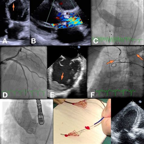A Four Chamber View From The Admission Tte Arrow Apical Thrombus