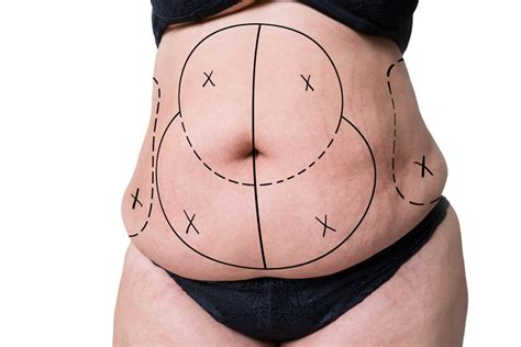 Recognizing The Signs Of A Bad Tummy Tuck