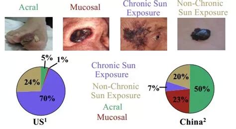 ASCO18中国之声郭军教授团队PD 1单抗JS001联合阿昔替尼一线治疗晚期粘膜黑色素瘤效果显著 肿瘤瞭望