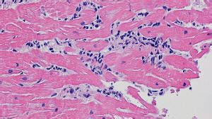 Heart Pathology