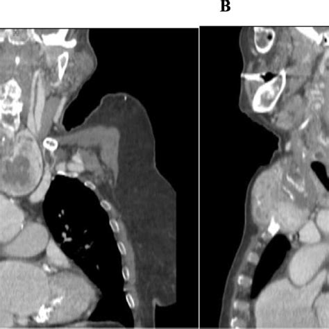 A Ct Scan Of The Head And Neck Showed A Left Thyroid Tumor B Ct