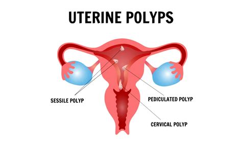 Polypectomy Tirath Ram Shah Hospital