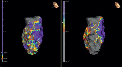 Figure 4 From Electroanatomic Mapping System The Useful Tool For