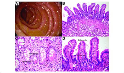 Normal Duodenal Mucosa A Endoscopic View Of Normal Duodenum With Download Scientific Diagram