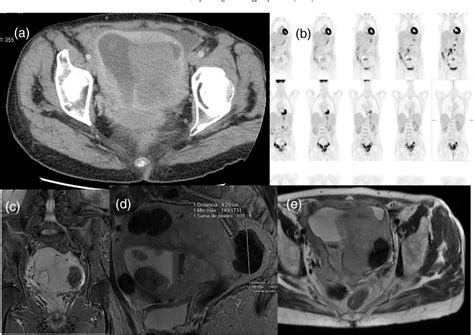 Figure 1 From Primitive Neuroectodermal Tumor Of The Uterus Semantic